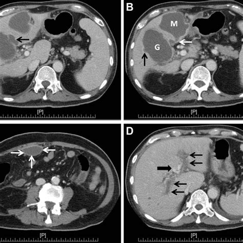 Contrast Enhanced Ct Scan A B Marked Gallbladder Distention G 55