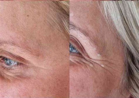 Does Sotorior Botulinum Toxin Help With Crows Feet Dermax