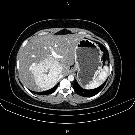 Focal Nodular Hyperplasia Pacs