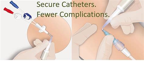 Secureportiv® The Adhesive Providing A New Gold Standard